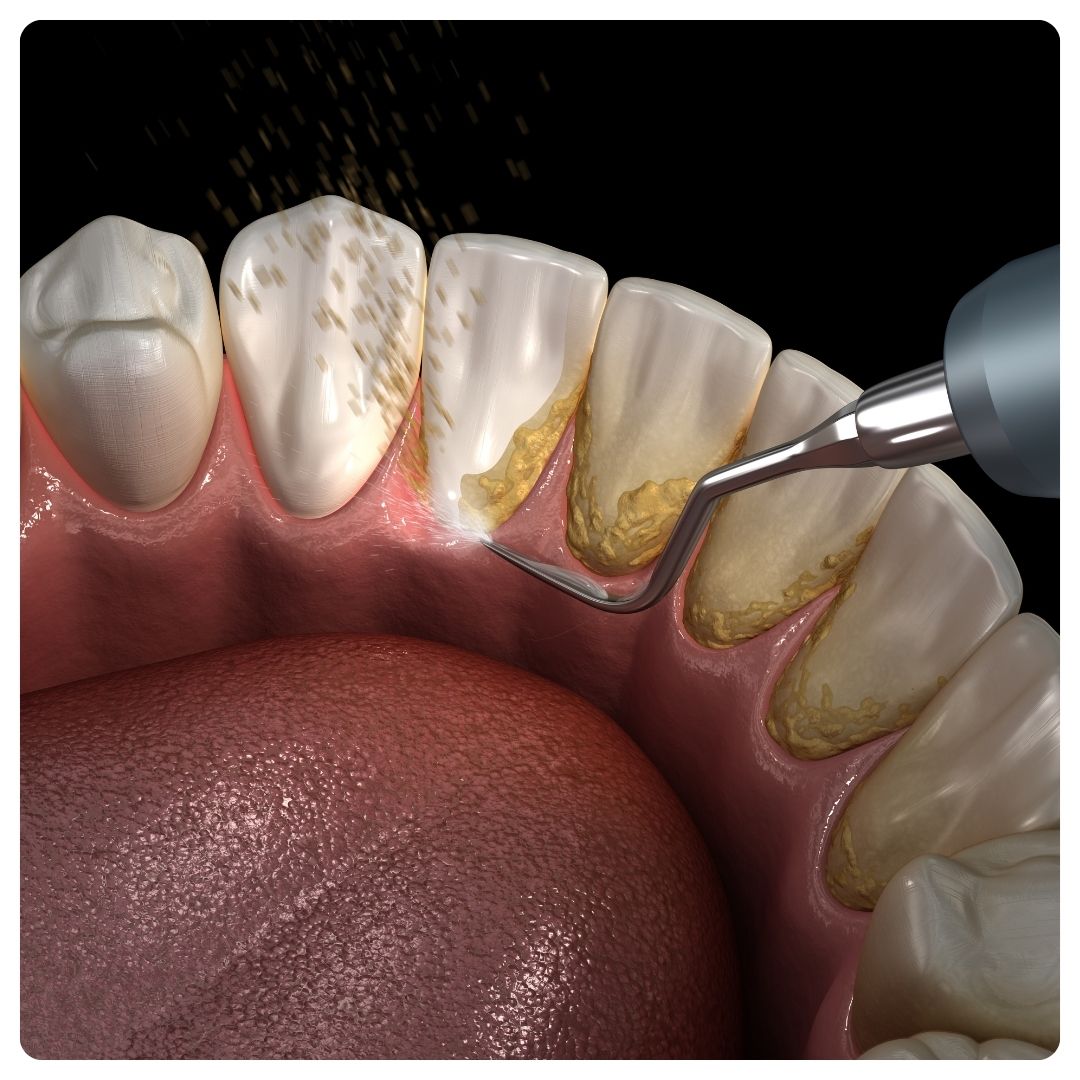 Teeth Scaling and Root Planing - Istanbul - Darya Dental Clinic