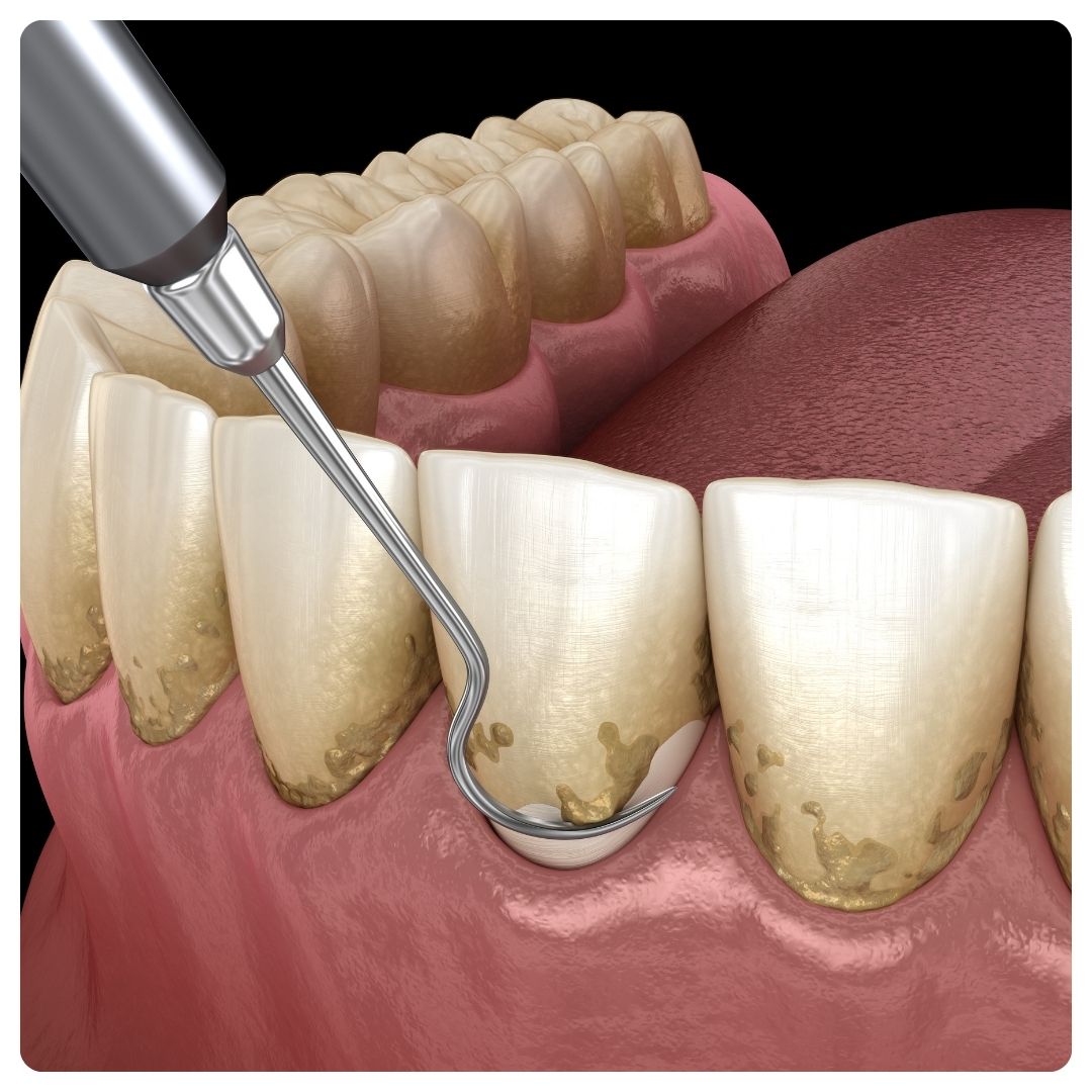 Teeth Scaling and Root Planing - Istanbul - Darya Dental Clinic