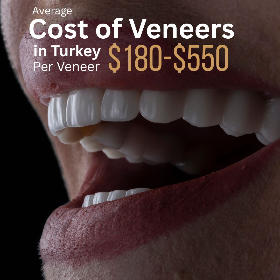 Porcelain Veneers Cost in Istanbul Turkey - 2025 - Darya Dental Clinic