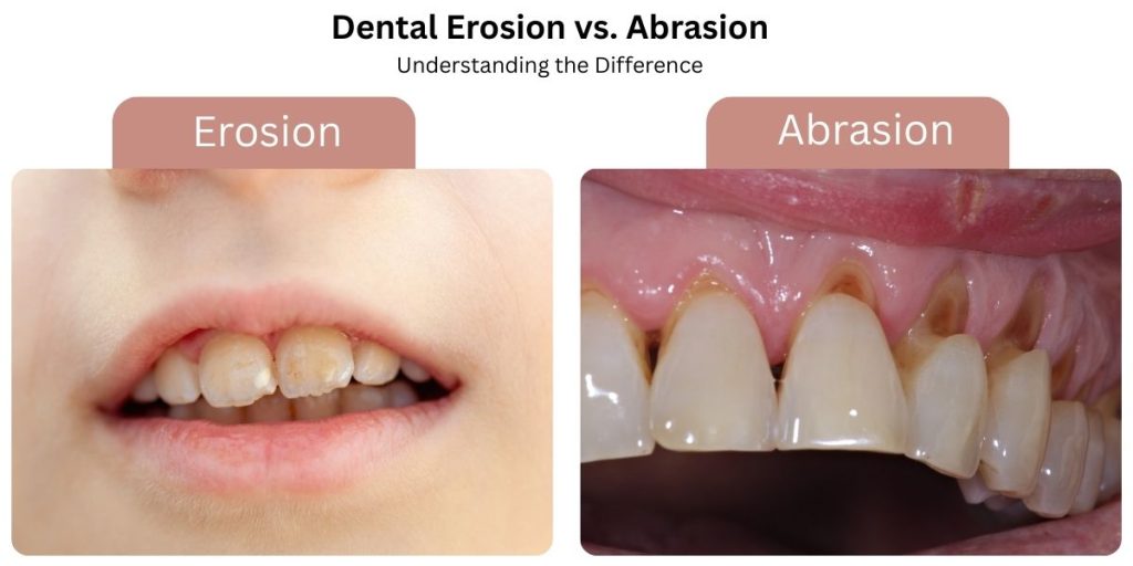Tooth Abrasion - Causes, Symptoms, and Solutions - Darya Dental Clinic
