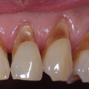 Tooth Abrasion: Causes, Symptoms and Solutions