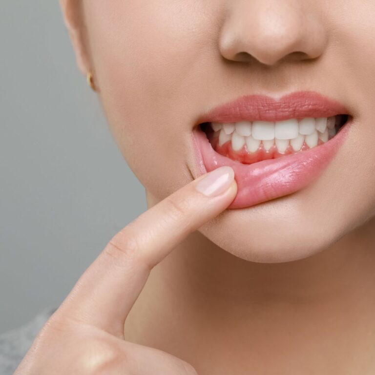 Receding Gums Causes and Treatment - Darya Dental Clinic